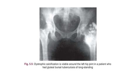Skeletal Tuberculosis Orthopaedics Seminar Pptx