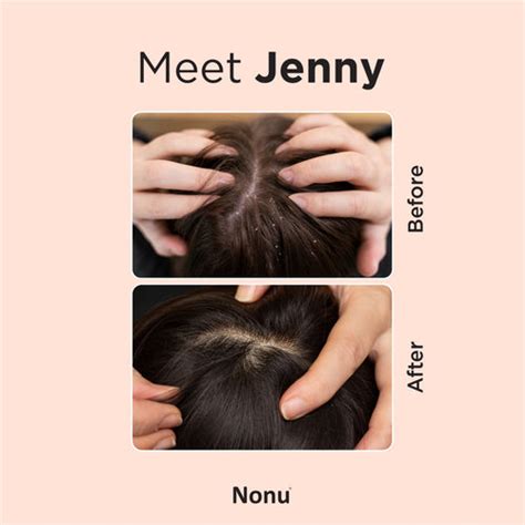 Anti Dandruff Ketoconazole Shampoo Nonucare