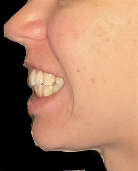 Help What Is Wrong With My Teeth Bite R Orthodontics