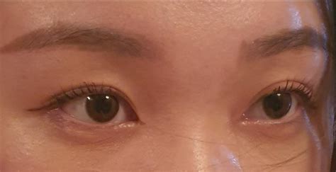 시술수술 질문 짝눈 쌍커풀 차이 강남언니 1등 성형수술and피부시술 정보앱