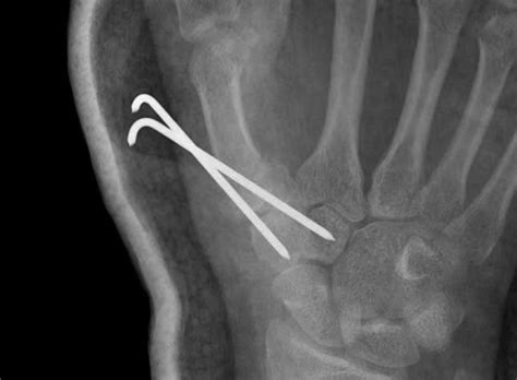 Base Of Thumb Fracture The Bone School
