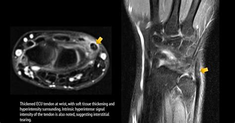 Ultimate Radiology Extensor Carpi Ulnaris Ecu Tendinosis With