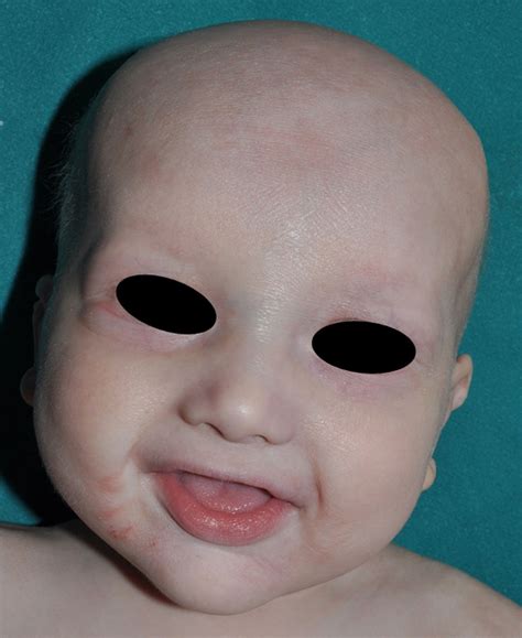 Ectodermal Dysplasia Syndrome Related Healthjournals Ectodermal