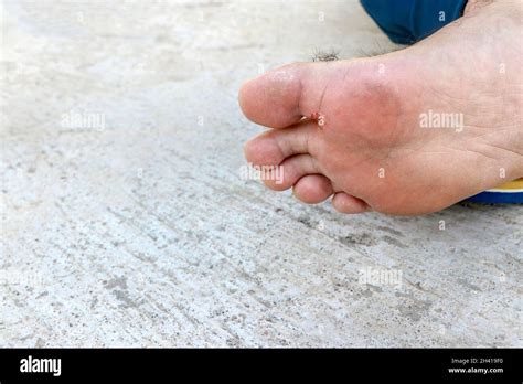 Athletes Foot Tinea Pedis Fungal Infection Or Sole Of The Feet With