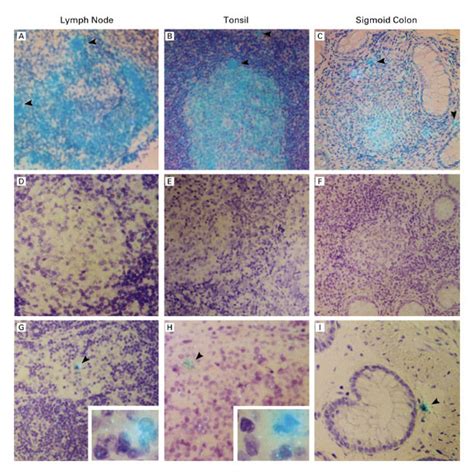 Quantifying Residual HIV 1 Replication In Patients Receiving