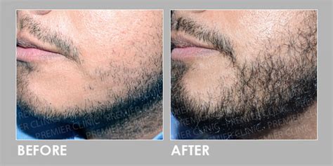 Fue Beard Hair Transplant Premier4him