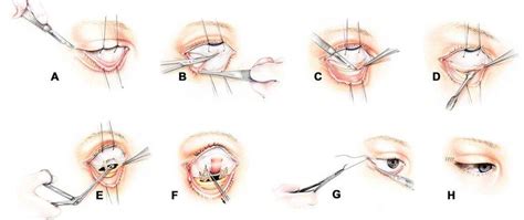 Orbital Decompression The Elza Institute