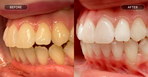 Aligners Before And After Overbite At Katie Felton Blog