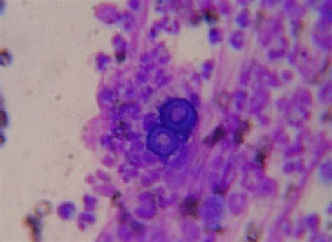 Blastomycosis Description Cause Symptoms Diagnosis And Treatment