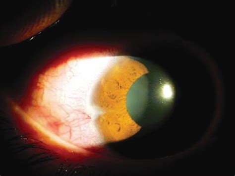 Late Occurrence Of Lens Particle Glaucoma Due To An Occult Glass