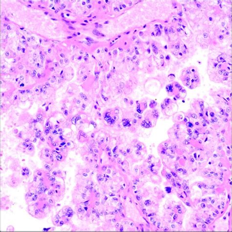 Tubulocystic Renal Cell Carcinoma Various Sized Micro And Macrocysts