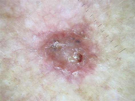 Basal Cell Carcinoma Dermoscopy Stock Image C0603436 Science Photo Library