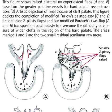 A D Veau Classification System Of Cleft Lip And Palate Download Scientific Diagram