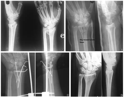 Scaphoid And Lunate Fossa