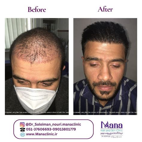کاشت مو ️ کلینیک تخصصی پوست و مو مانا