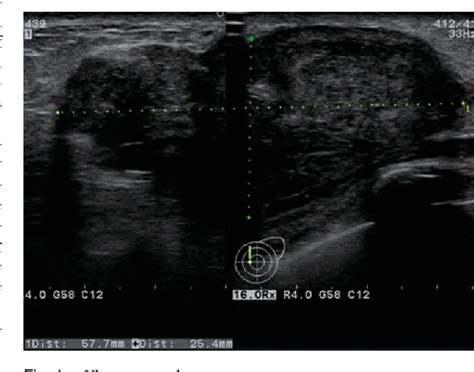 Figure 1 From A Case Of Adenoid Cystic Carcinoma Of The Breast