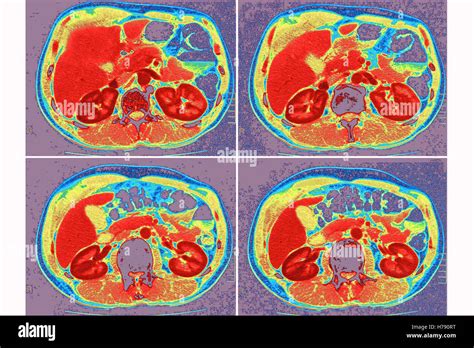 Ct Scan Abdomen High Resolution Stock Photography And Images Alamy