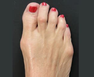 Tailors Bunion Da Vinci Foot And Ankle