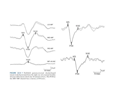 Visual Evoked Potentials Pptx
