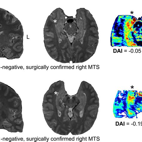 Glucest And Mri Comparisons Coronal Left And Axial Middle 3t T2w