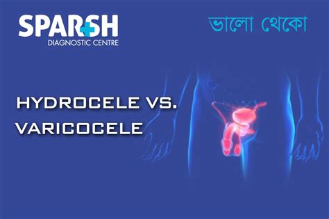 Hydrocele Vs Varicocele Sparsh Diagnostic Center