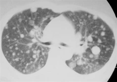Rad Files Woman With Multiple Lung Lesions