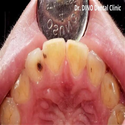 Cavity Object Detection Dataset V3 2023 04 24 1 35pm By Jongboo