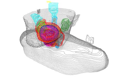 3d Printing Radiotherapy Contours Radiation Analytics Calculate The