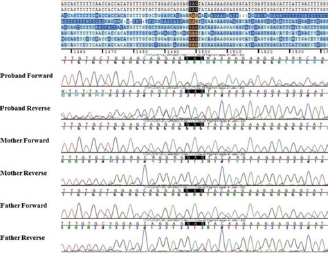 A Novel De Novo Mutation In Myh7 Gene In A Patient With Early Onset