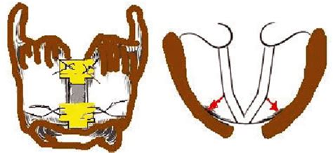 Spasmodic Dysphonia Ento Key