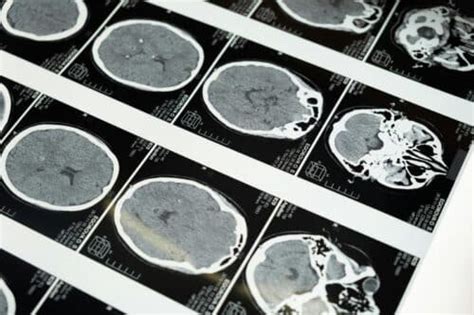 Does Weed Kill Brain Cells What Science Really Says Prestodoctor
