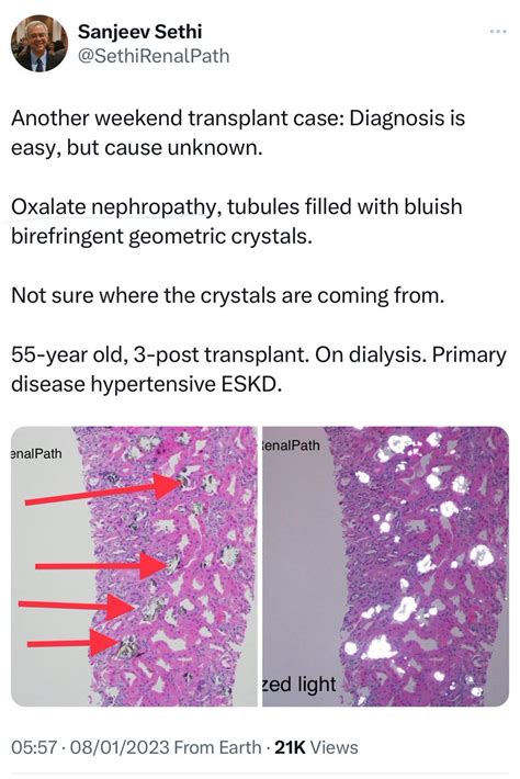 Summary Of Nondrug Related Interstitial Nephritis Nephsap 🧵 Thread