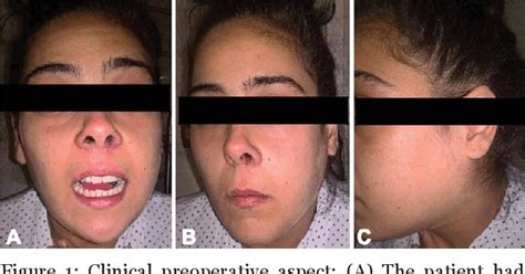 Figure 1 From Deep Neck Space Infections An Odontogenic Parapharyngeal Abscess Reaching The