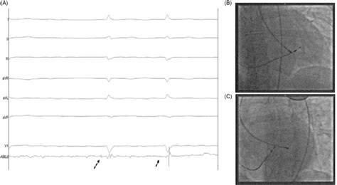 Intracardiac Electrogram Recordings A From The Download
