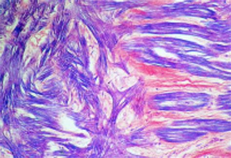 Hypertrophic Cardiomyopathy The Interrelation Of Disarray Fibrosis
