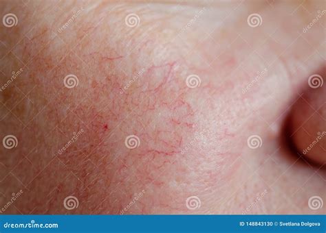 Ci Rrese Para Arriba De Piel Del Rostro Humano Con Problemas Vasculares