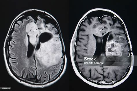 뇌종양 Mri 뇌종양에 대한 스톡 사진 및 기타 이미지 뇌종양 Mri 스캔 0명 Istock