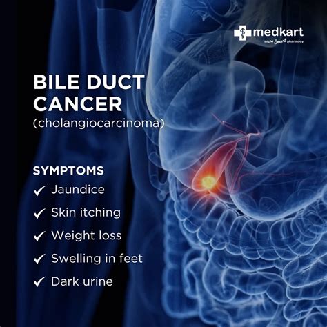Medkart 📢 Understanding Bile Duct Cancer Cholangiocarcinoma Bile