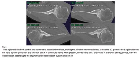 Uw Shoulder And Elbow Academy Shoulder Arthritis How May Glenoid