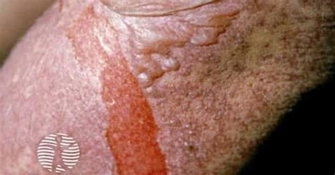 Staphylococcal Scalded Skin Syndrome Image