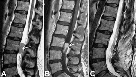 Preoperative Post Contrast Sagittal T2 Weighted A And T1 Weighted B