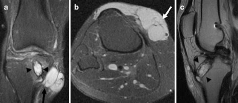 Tibial Tunnel Cyst Formation With Extension Into The Pretibial Soft Download Scientific Diagram
