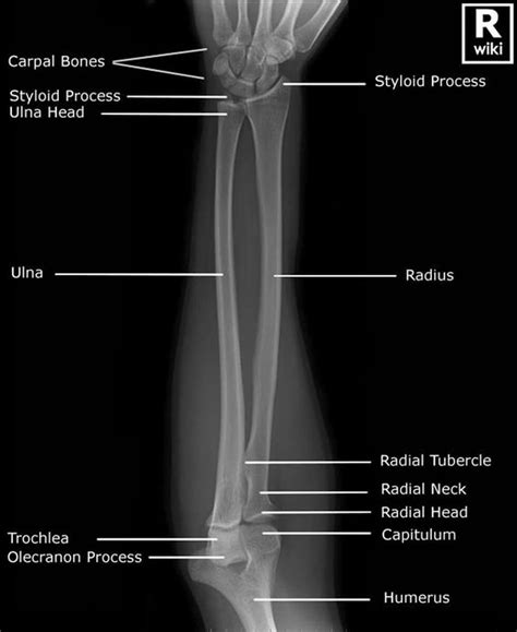 An X Ray Image Shows The Bones And Their Major Skeletal Structures