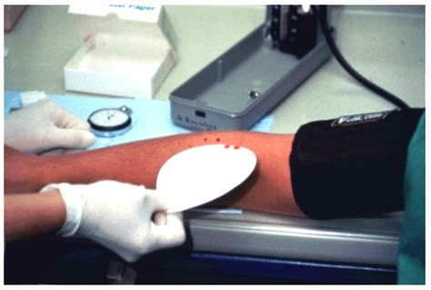 Bleeding Time Normal Range Archives Medicoinfo