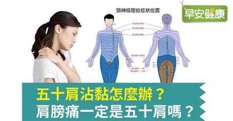 我得五十肩了嗎？五十肩初期症狀、惡化原因與治療，醫師完整解析