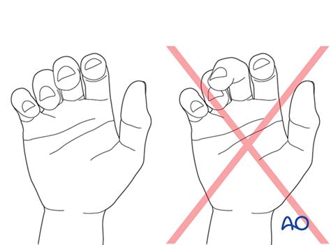 Closed Reduction Splinting For Extraarticular Fracture Of The Proximal End Segment