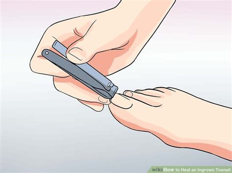 3 Ways To Heal An Ingrown Toenail Wikihow