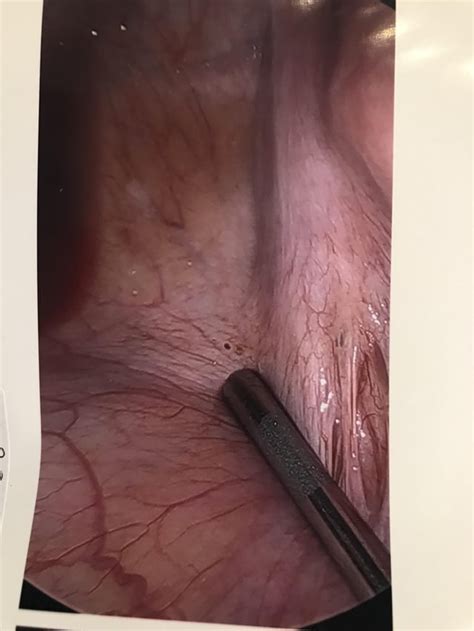 Laparoscopy Photos Waiting Biopsy Results Rendo