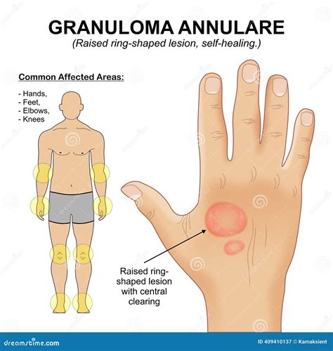 Granuloma Annulare Chronic Hand Skin Disease Symptoms Medical