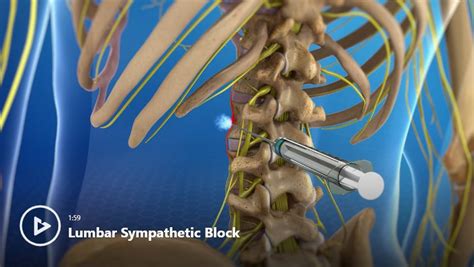 Lumbar Sympathetic Block Video Newport Orthopedic Institute